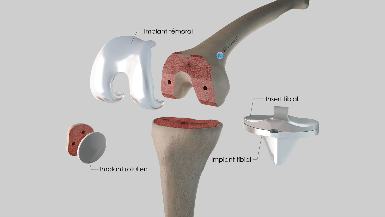 Chirurgie prothèse totale de genou Turquie : Guide Arthroplastie du Genou