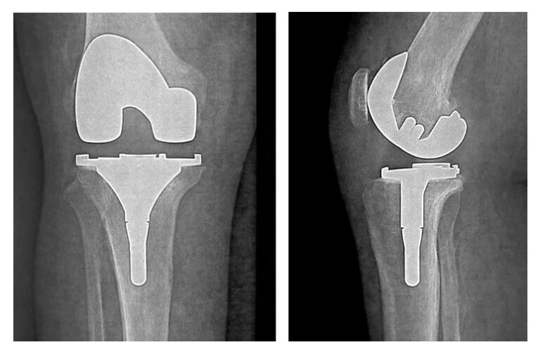 Chirurgie prothèse totale de genou Turquie : Guide Arthroplastie du Genou