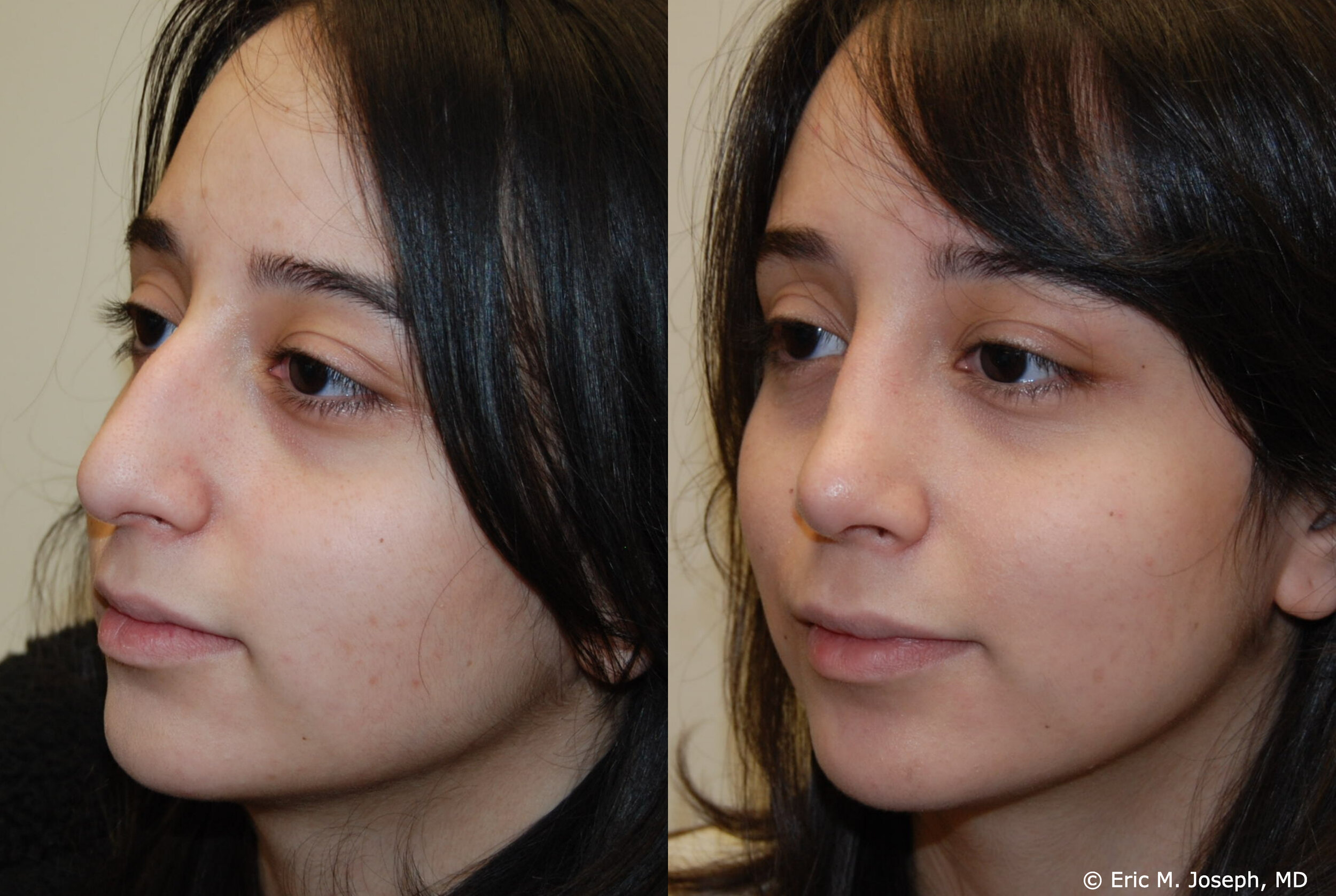 Bulbous Nose Tip Correction in Turkey: Costs & Options