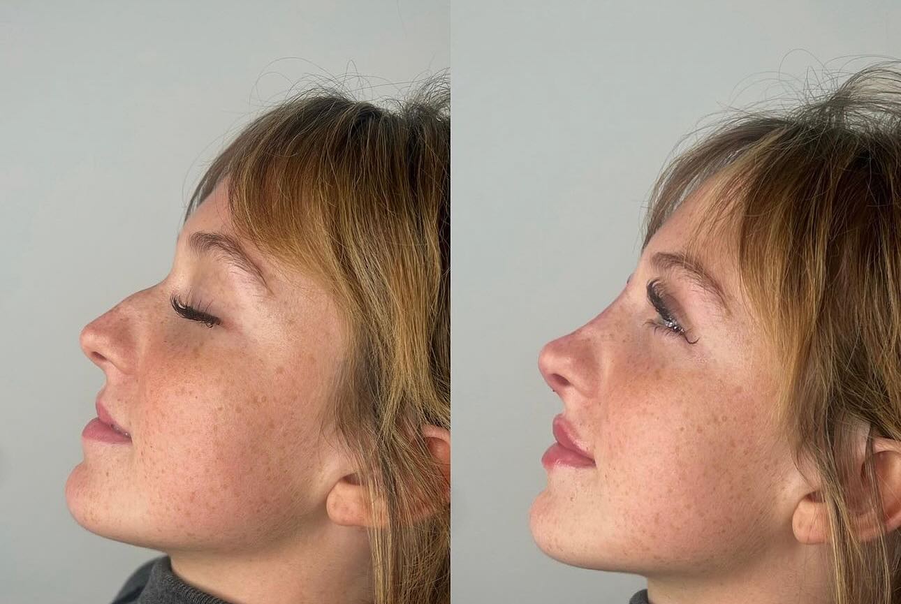 Tendance Nez de Barbie : Ce qu'il faut savoir sur cette rhinoplastie ...