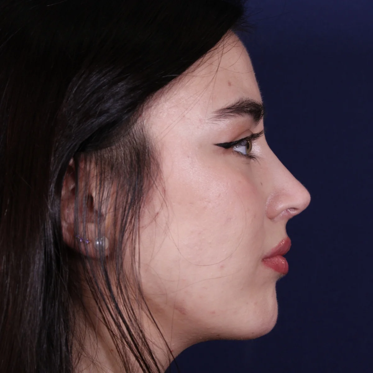 Rhinoplastie Barbie Nose + Keratopigmentation en Turquie tout compris